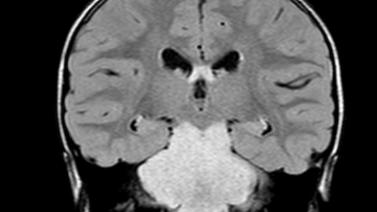 GD2 CART DIPG TRIAL - Campaign